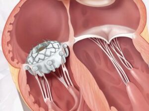 Edwards LifeSciences Reports Positive Clinical Updates on its ...